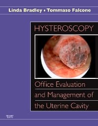 Hysteroscopy: Office Evaluation and Management of the Uterine Cavity ...